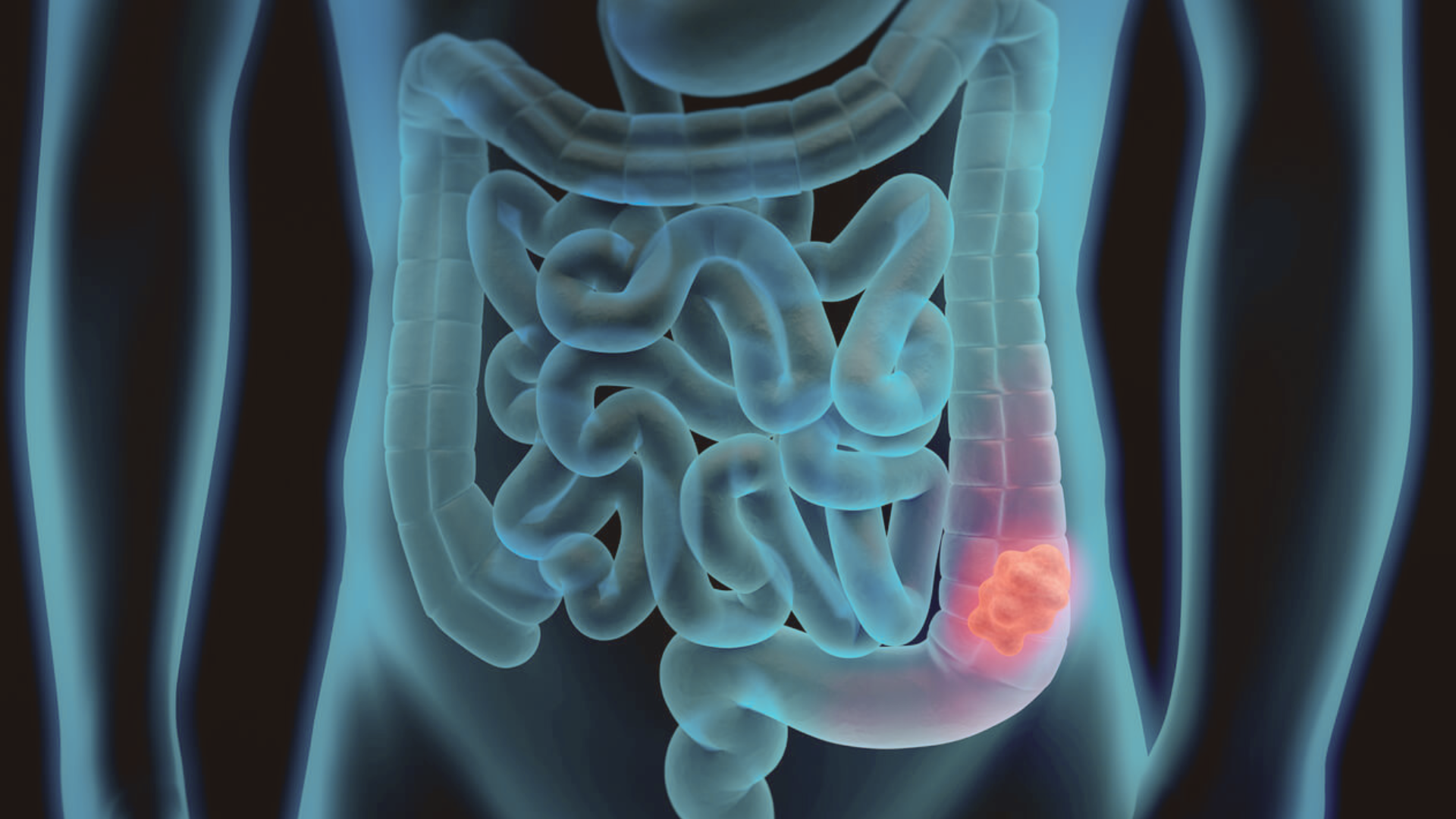 Beating Bowel Cancer Why Test B Assured